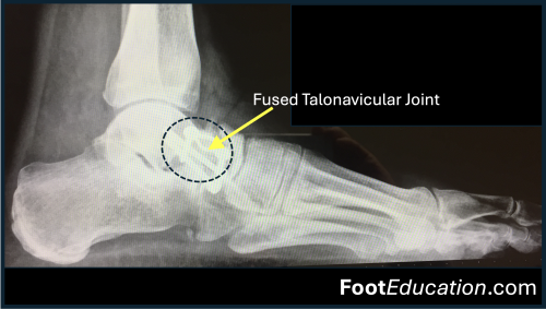 Talonavicular Fusion - FootEducation