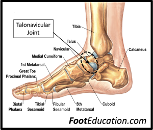 Talonavicular Arthritis - FootEducation