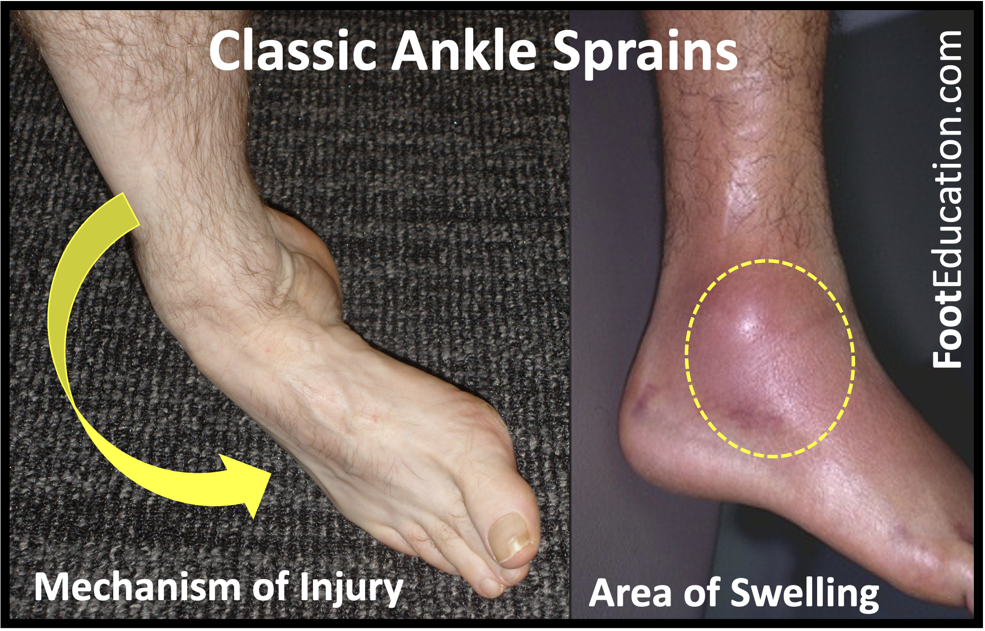 When an Ankle Sprain Isn’t Just an Ankle Sprain! - FootEducation