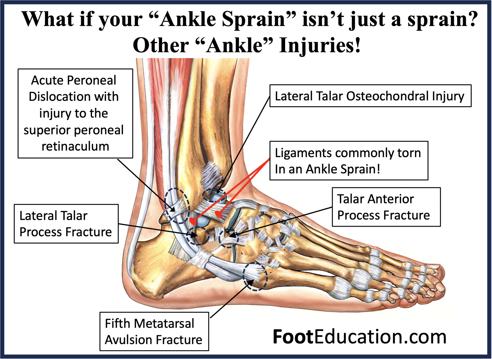 When an Ankle Sprain Isn’t Just an Ankle Sprain! - FootEducation