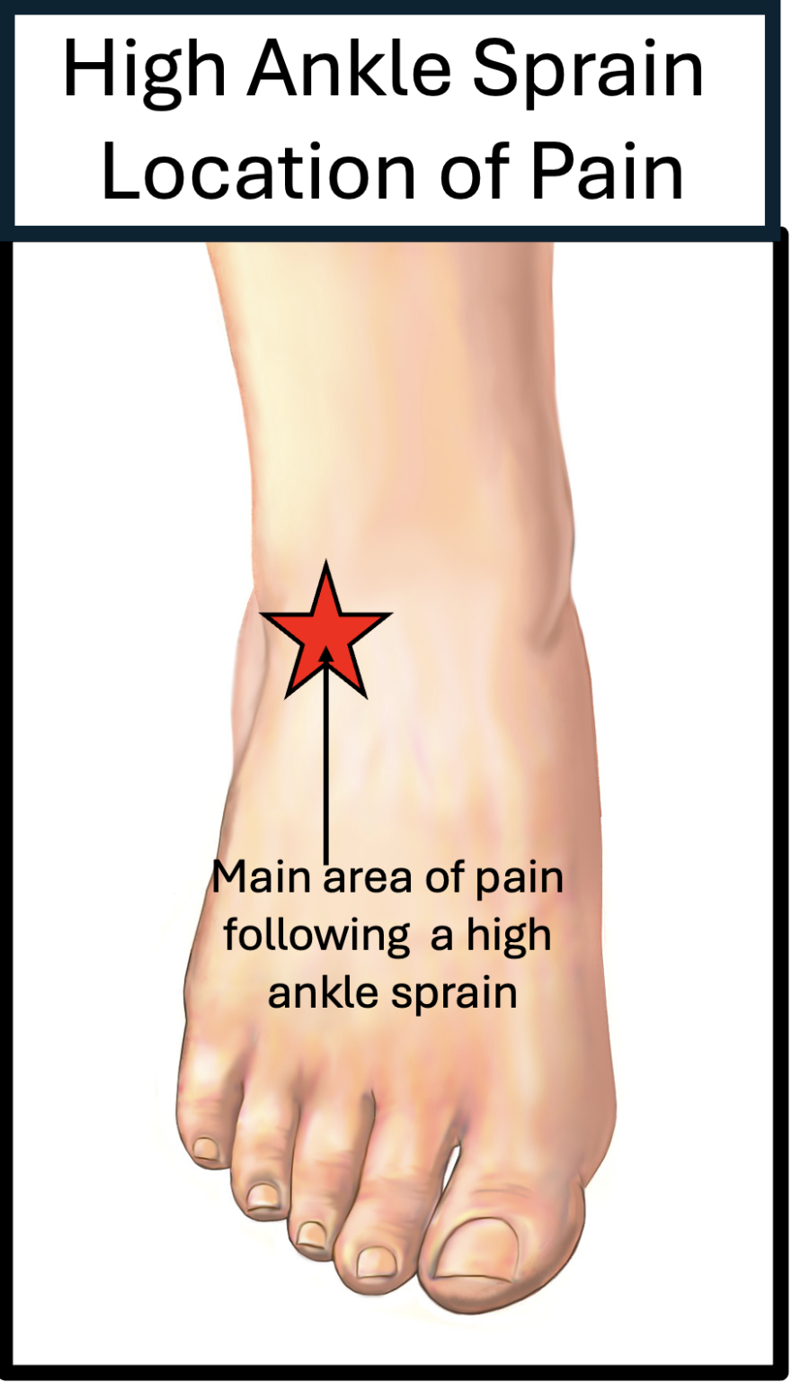High Ankle Sprain - FootEducation